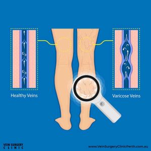 Endovenous laser ablation (EVLA) - Vein Surgery Clinic of Perth